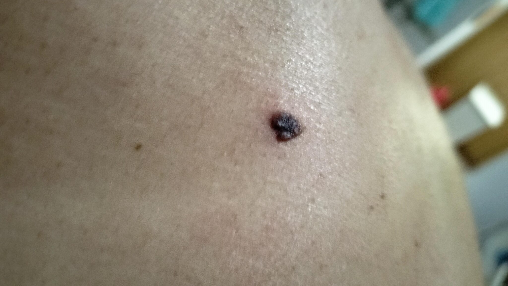 ほくろの痛みは悪性黒色腫のサイン？背中のほくろに気をつけるべき理由 50代からの健康習慣ブログ｜長生き・若々しく生きる秘訣